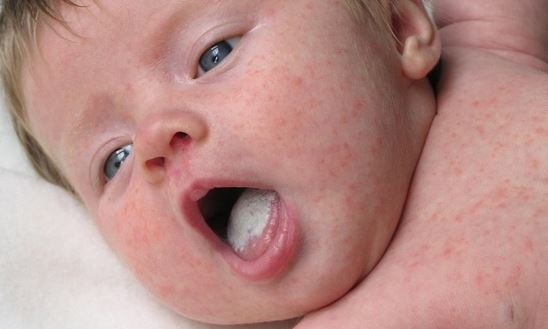 La candidiasis oral en los bebés - Síntomas y tratamiento